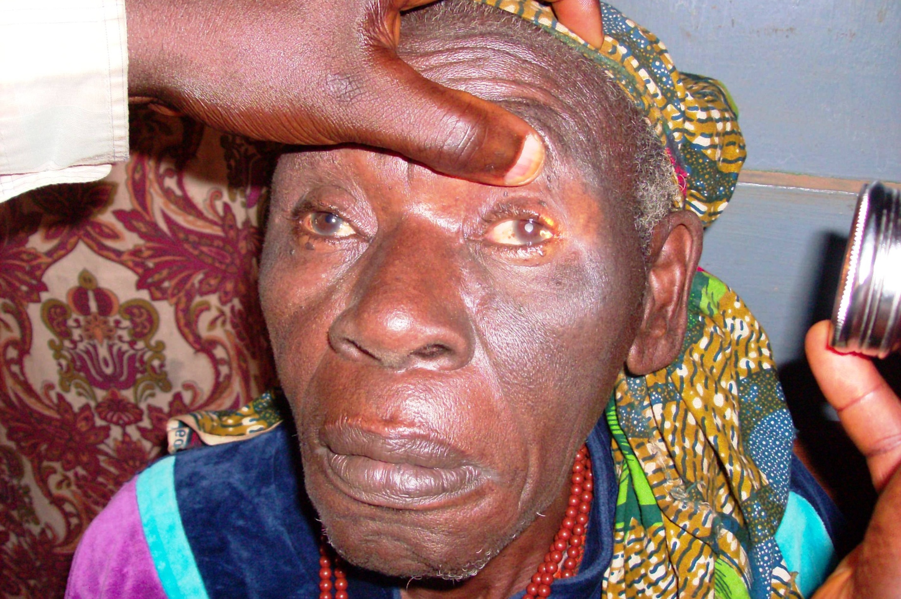 Prevent Blindness-Fund Cataract Surgeries Cameroon - GlobalGiving