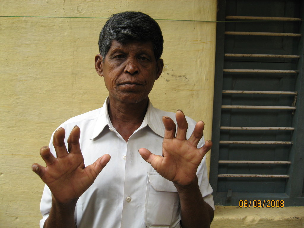 Free Medical Care for Poor Lepers - GlobalGiving