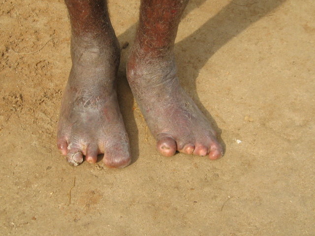 Free Medical Care for Poor Lepers - GlobalGiving