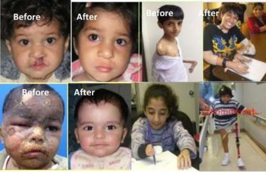 How to Share Medical Treatment for 100 Burn Children - GlobalGiving