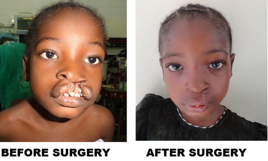 How to Share FREE FACIAL DEFORMITY SURGICAL OUTREACH PROGRAMME ...