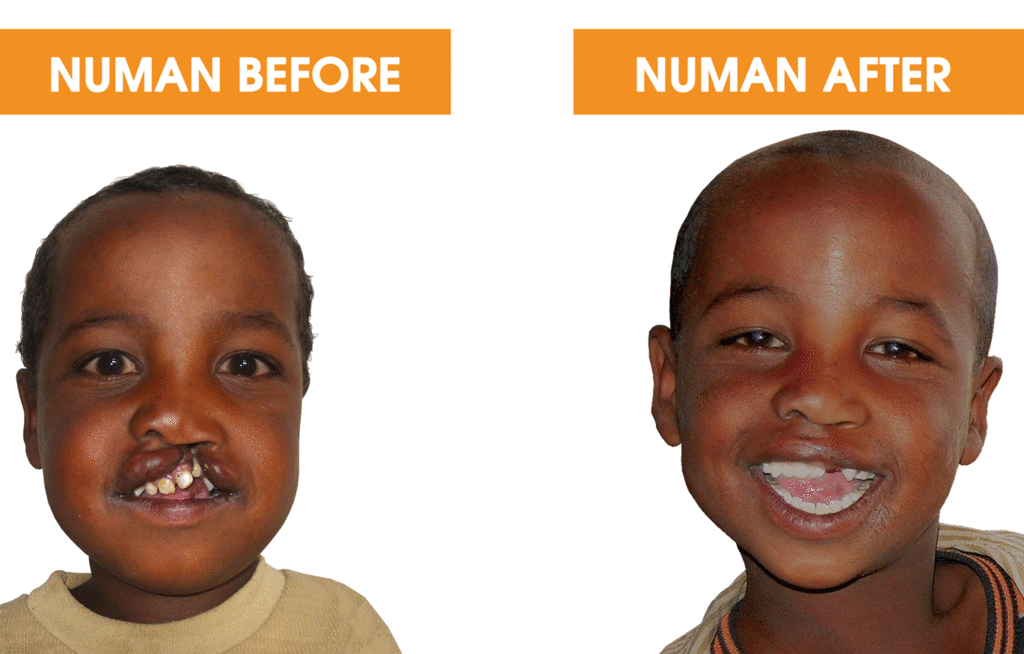 Help 40 Ethiopian Children with Cleft Conditions - GlobalGiving