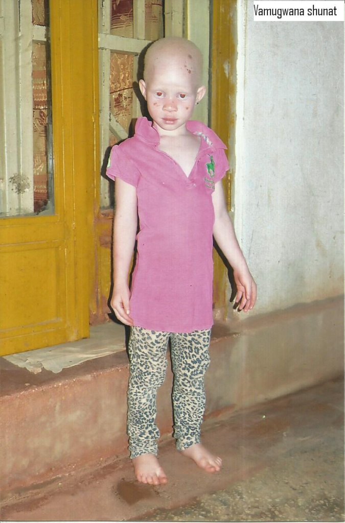 Build a School for 200 Children with Albinism - GlobalGiving