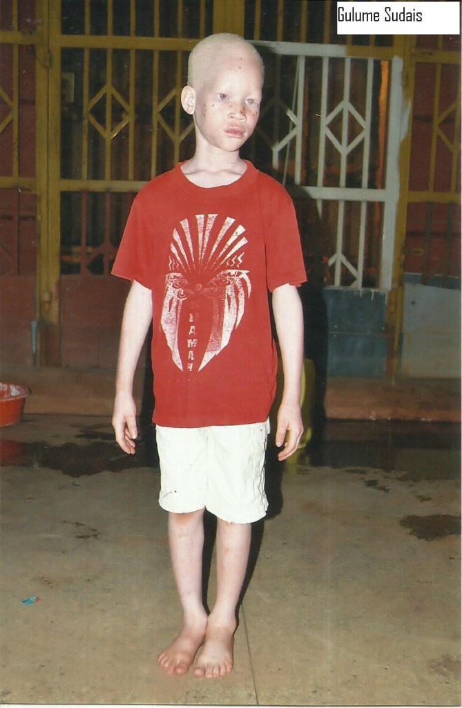 Build a School for 200 Children with Albinism - GlobalGiving