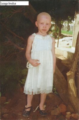 Build a School for 200 Children with Albinism - GlobalGiving