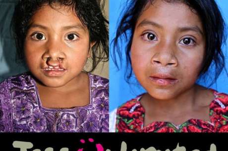 Surgery for 20 children born with cleft lip - GlobalGiving