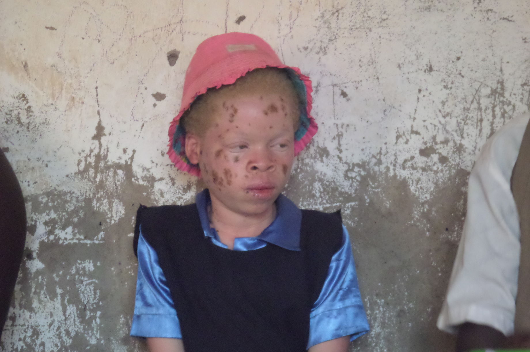 Increase protection for 2000 Albinos in Malawi. - GlobalGiving