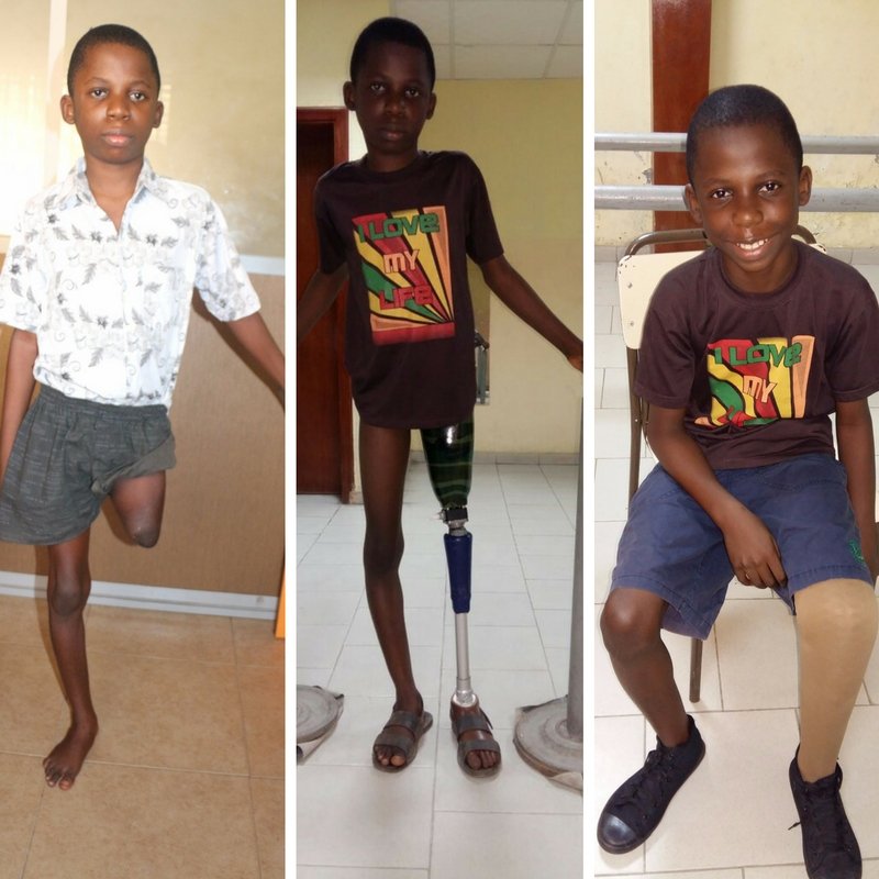 Provide Limbs to 20 Child Amputees in Nigeria - GlobalGiving