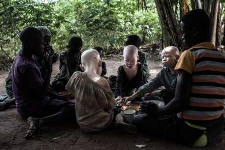 Improving the lives of People with Albinism - GlobalGiving