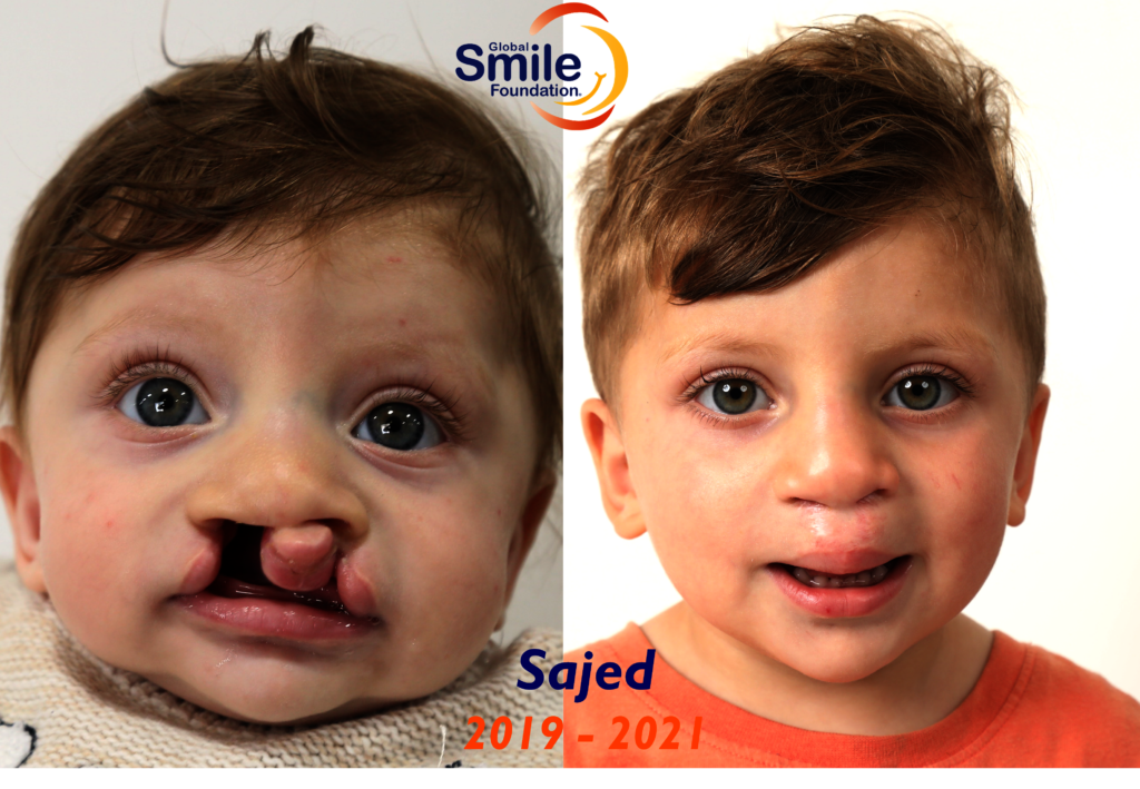 Help 10 Children Born with Cleft in Lebanon/MENA - GlobalGiving