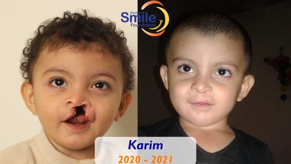 Help 10 Children Born with Cleft in Lebanon/MENA - GlobalGiving