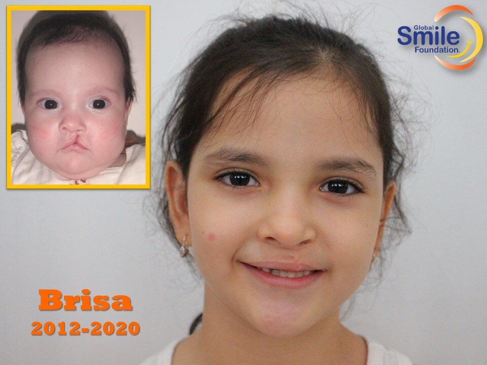 Saving Lives for Children born with Cleft - GlobalGiving