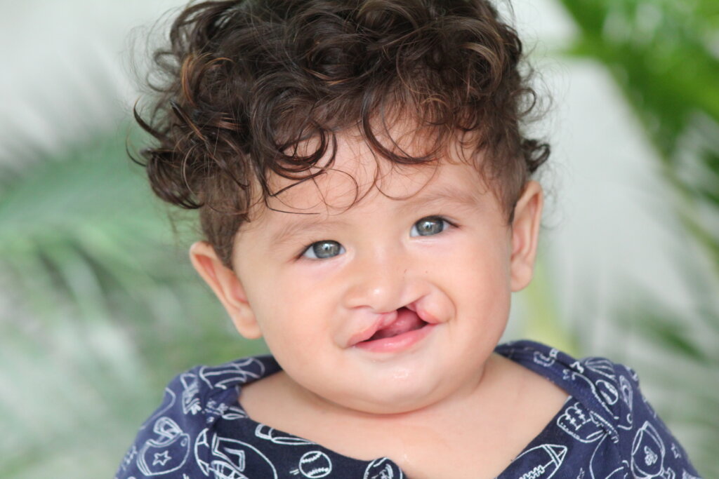 Saving Lives for Children born with Cleft - GlobalGiving
