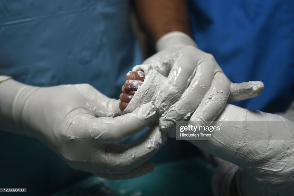 Club foot project for the marginalized children - GlobalGiving