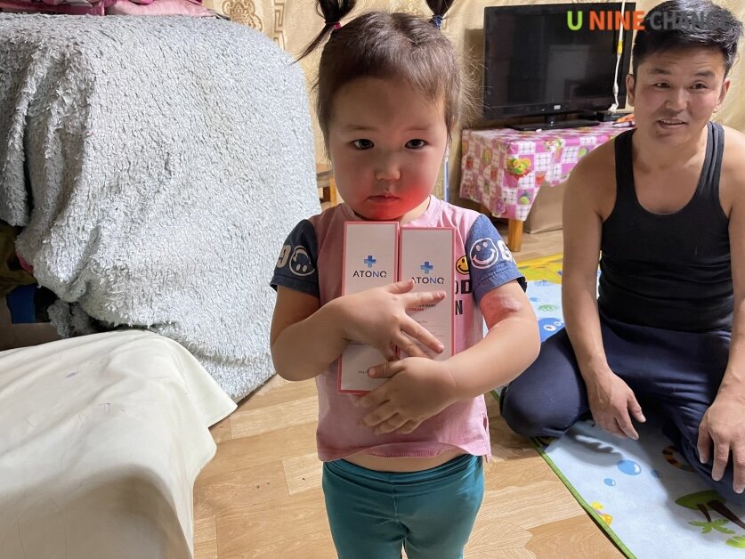 Treatment support for burn children in Mongolia - GlobalGiving