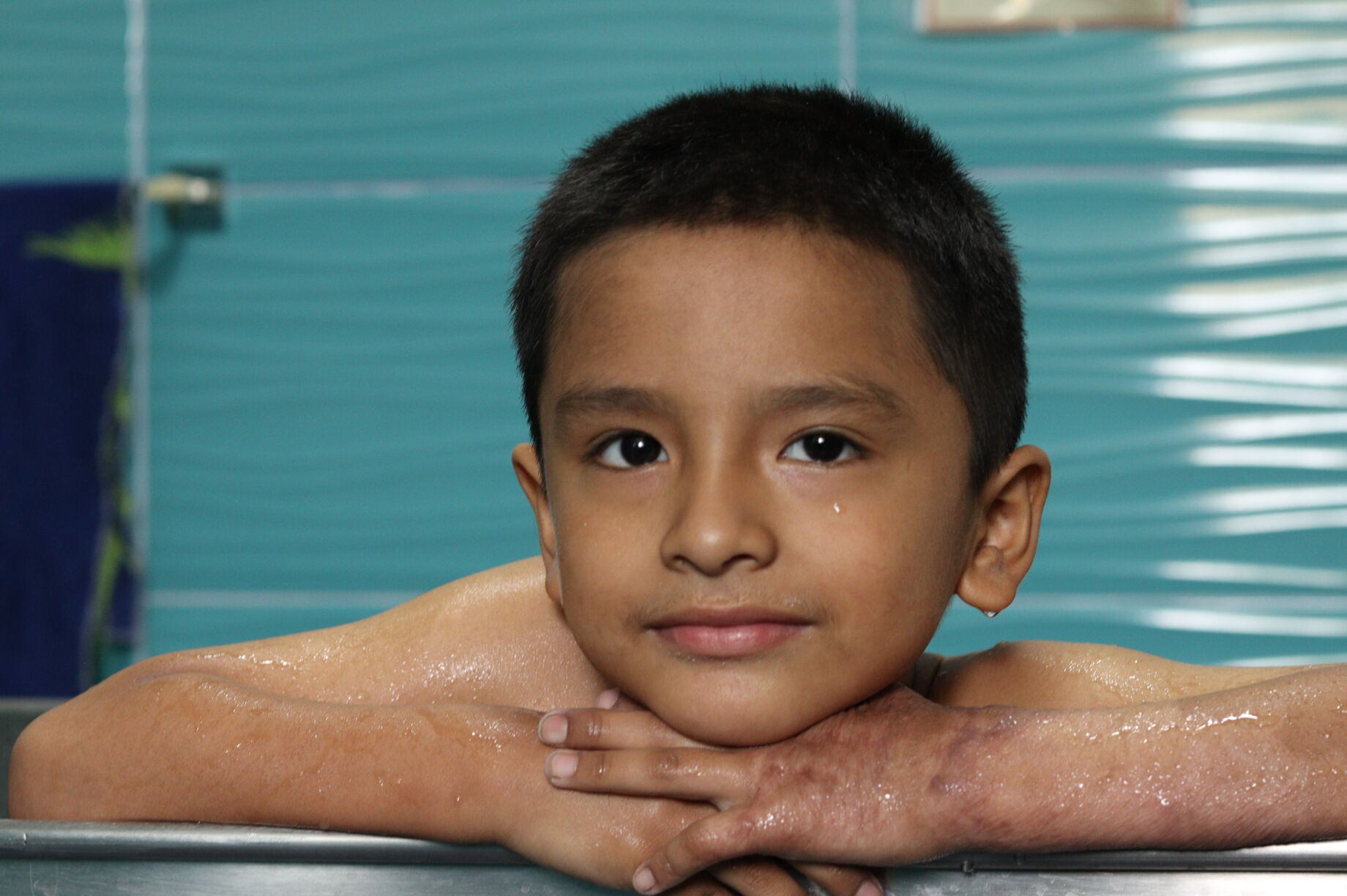 Burn children need your help! - GlobalGiving